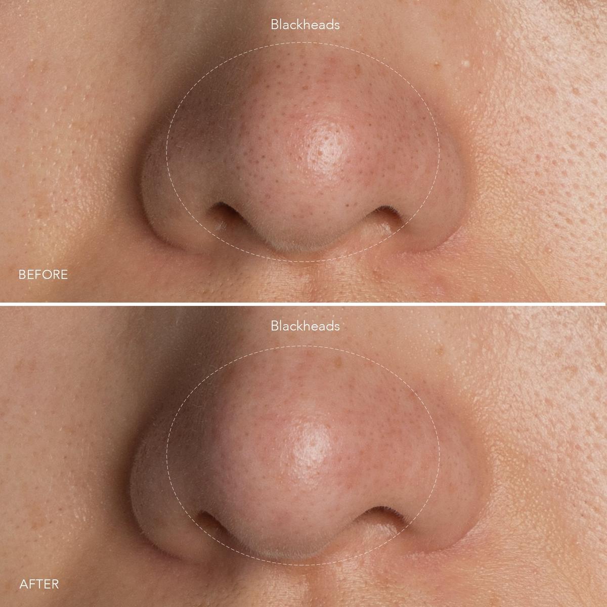 Foreo Kiwi Blackhead Remover